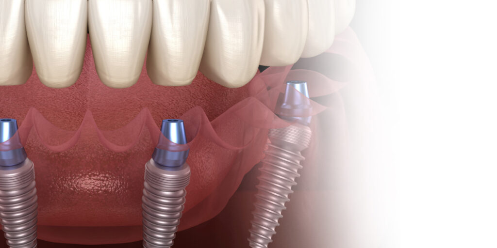 All On 4 Dental Implants Plano TX | Dental Implants | Plano Smile Studio